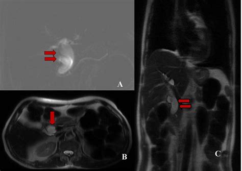 A Cholangio Mri Sequence Showing Dilatation Of Common Bile Duct B Download Scientific