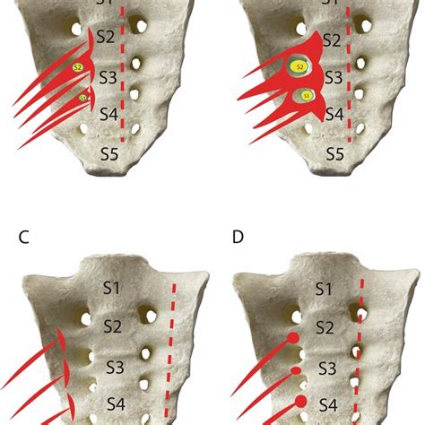 Schematic Representation Of The Patterns For The Piriformis Origin A