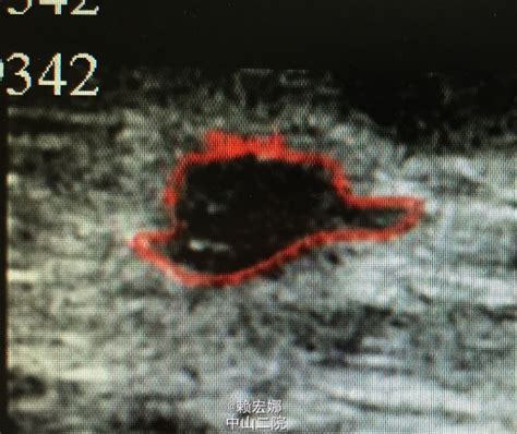 左侧腋窝肿大淋巴结最后确诊是乳腺癌 医联