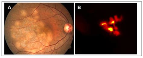 An Eye On Tuberculosis In The Eye Welthi Healthcare Tips And News Daily Health Tips