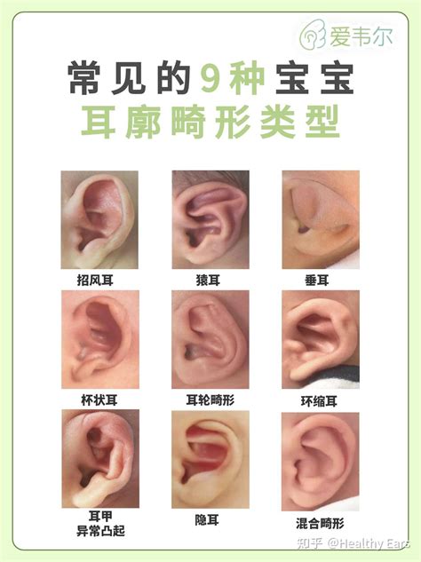 宝宝耳廓畸形自查辨别4步骤👂🏻 知乎