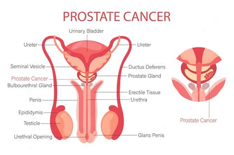 Premium Vector Prostate Cancer Male Reproductive System Anatomy Of