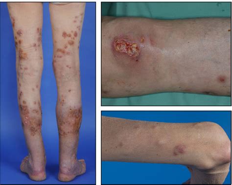 Clinical Picture Approximately 12 Weeks After First Onset Multiple Download Scientific