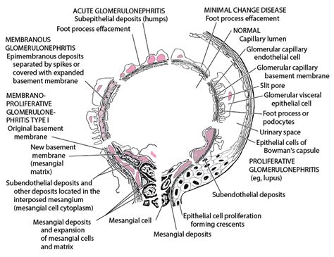 Membranous Nephropathy Genitourinary Disorders Msd Manual