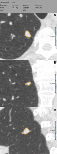 Lung Nodule Management In Low Dose Ct Screening For Lung Cancer Lessons From The Nelson Trial