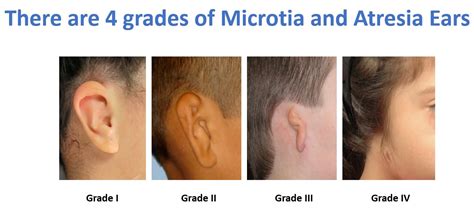 Ear Here Are Some Statistics About Our Rare Cause Microtia And Aural