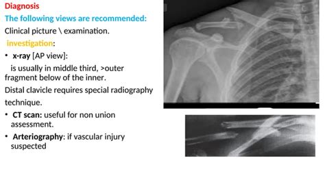 Fracture Of The Clavical Clinical 2 Pptx