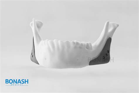 پروتز زاویه فک شخصی‌سازی‌شده زاویه سازی فک