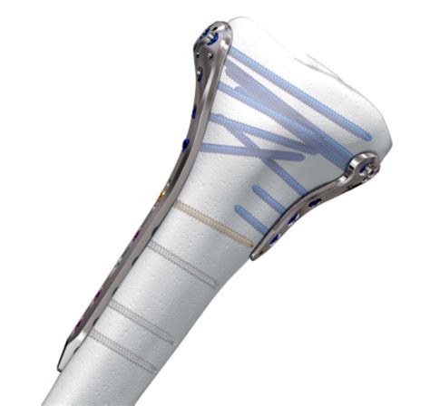 Proximal Tibia Plate Medline Uae