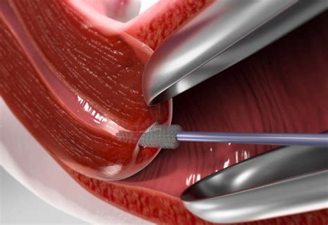 Self Sampling Hpv Test Set To Eliminate Cervical Cancer In Malaysia