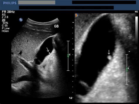 Gallbladder Polyps Ultrasound