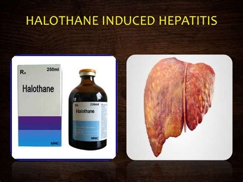 Halothane Induced Hepatitis