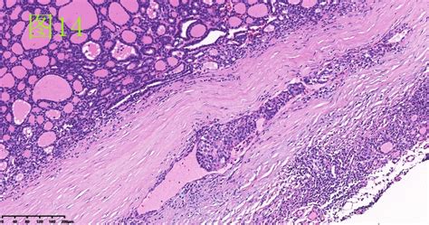 病例分享:青年甲状腺滤泡癌1例 资讯频道 华夏病理网 病例分享:青年甲状腺滤泡癌1例 资讯频道 华夏病理网
