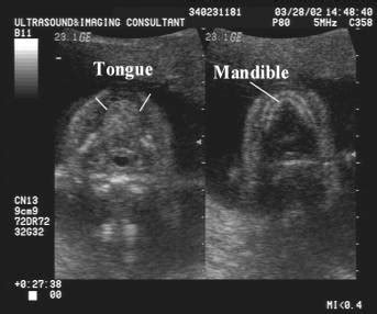 Normal Fetal Tongue