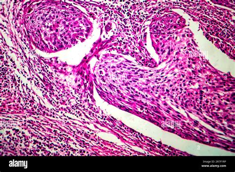 Cervical Cancer Light Micrograph Lm Of A Section Through A Squamous