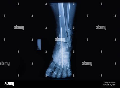 Lower Leg Fracture Pin Hi Res Stock Photography And Images Alamy