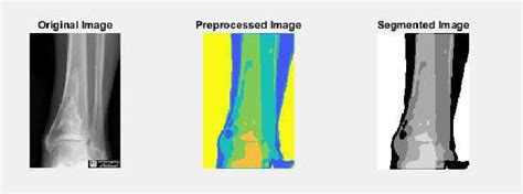 Figure 1 From Feature Extraction And Classification Of Bone Tumor Using