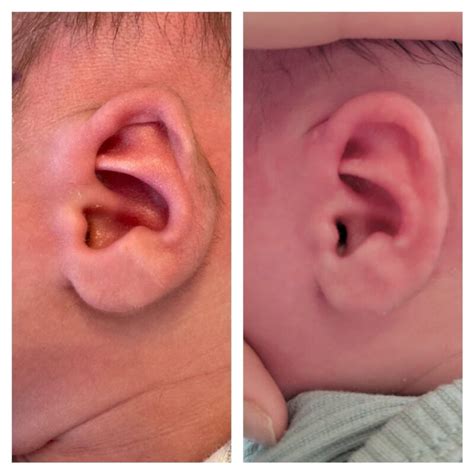 Treatment Of Prominent And Constricted Ear Anomalies Infant Ear