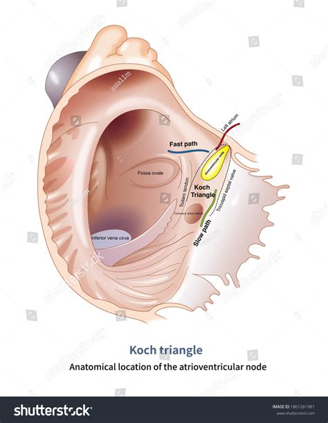 Anatomical Location Atrioventricular Nodeduring Radiofrequency Ablation Stock Illustration