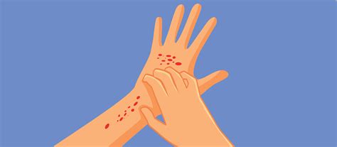 Learn About Mrsa Infection Diagnosis Treatment Prevention Buzzrx
