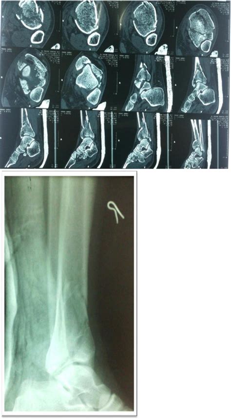 Figure 1 From Management Of Tibial Pilon Fractures With Spanning