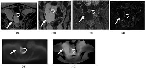 Utility Of The Diffusion Weighted Sequence In Gynecological Imaging
