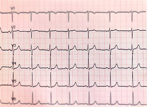 Saving Lives Understanding And Treating Pulseless Ventricular Tachycardia Vt