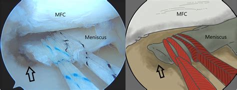 Transosseous Fixation With Suspensory Fixation System On Medial