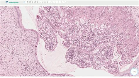 Endocervical Polyp Uterine Cervix Histopathology Youtube