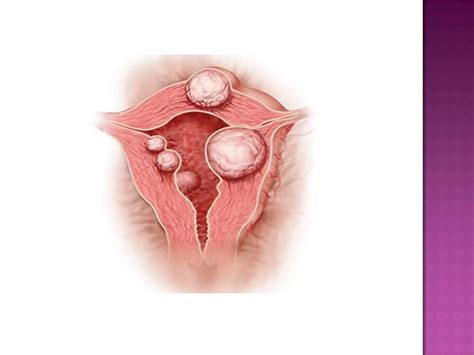 Fibroids And Infertility Ppt
