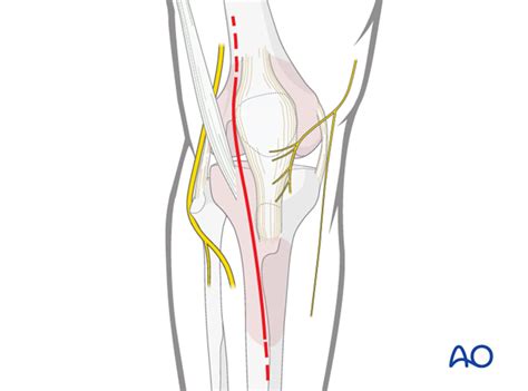 Anterolateral Approach To The Proximal Tibia