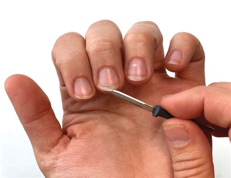 Mineral Oil Scabies Preparation From Under The Fingernail Mdedge