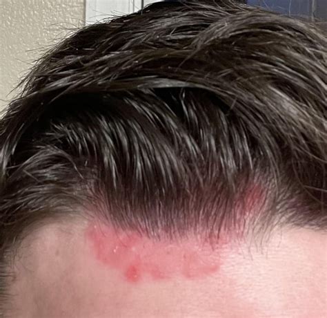 Red Scaly Patches On Face Rdermatologyquestions