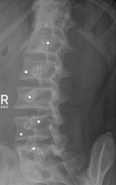 Lumbar ~ Anteroposterior Oblique Right Posterior Oblique Rpo X Ray