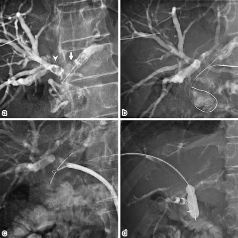 Figure3 Case 1 A Percutaneous Transhepatic Cholangiogram
