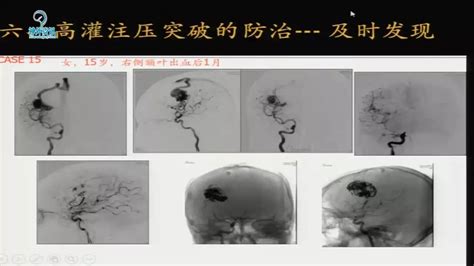 夏鹰教授：脑血管畸形介入治疗的并发症及防治 脑医汇