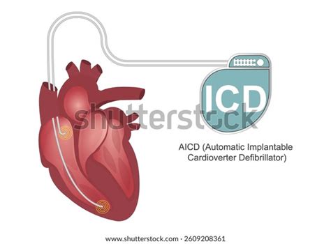 Automated Implantable Cardioverter Defibrillator Icd Aicd Stock Vector Royalty Free 2609208361