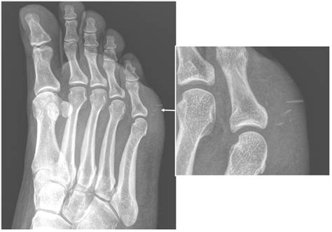 Tapeworms In Humans Xray