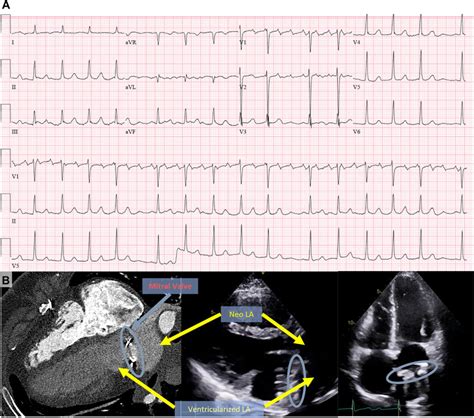 Atypical Flutter In A Patient With A Supra Annular Mitral Valve Download Scientific Diagram