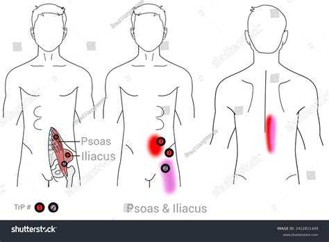 Myofascial Trigger Point Psoas Iliacus Stock Illustration 2412811409 Shutterstock