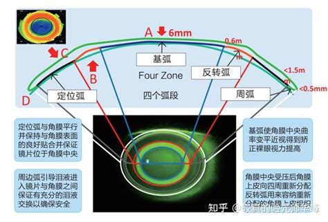 离焦镜片有用吗不同离焦镜片的离焦量该如何选择 知乎