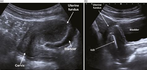 Uterus Anatomy Ultrasound Female Ultrasound Phantom Vaginal Training