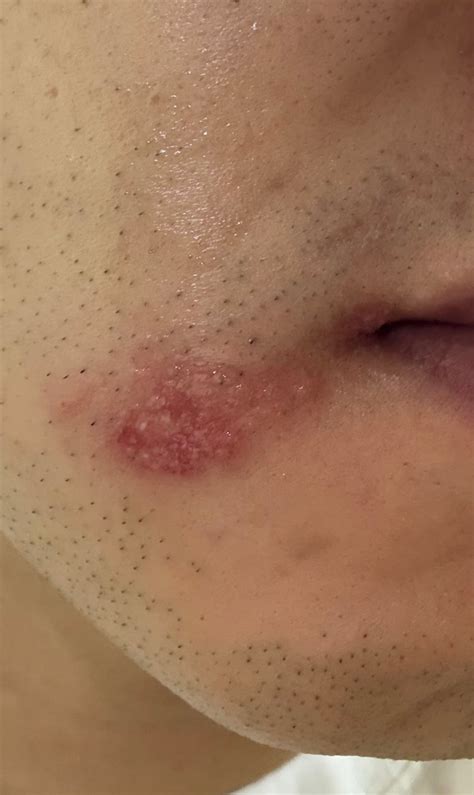 얼굴 두드러기 따가움 딱딱함 지식in