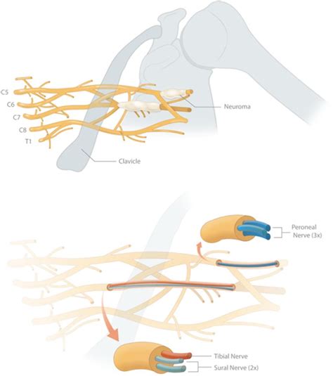 The Journal Of Bone And Joint Surgery Inc On Linkedin Brachial Plexus Reconstruction Using