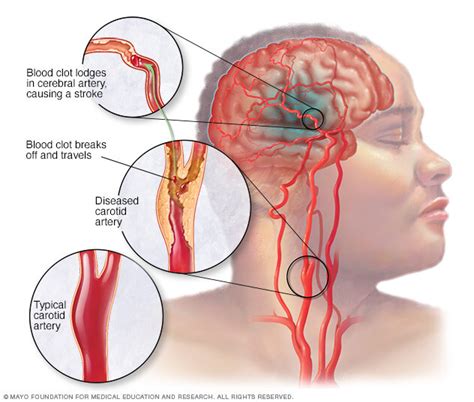 Carotid Ultrasound