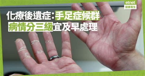 【化療後遺症】化療後易有「手足症候群」：手腳腫痛、龜裂、生水泡，嚴重會骨枯 健康解「迷」 醫學通識 健康好人生 Etnet