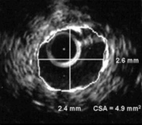 Stent Post Dilatation Conic Vascular
