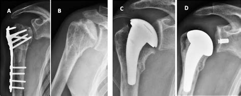 Pyrocarbon Hemiarthroplasty Of The Shoulder Indications And Pitfalls