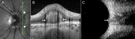 Peripapillary Hyperreflective Ovoid Mass Like Structures—a Novel Entity