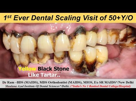 Calculus Teeth Black